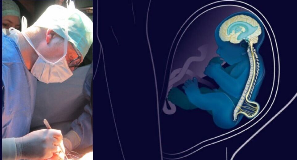 Operert i mammas mage - RH-foreningen